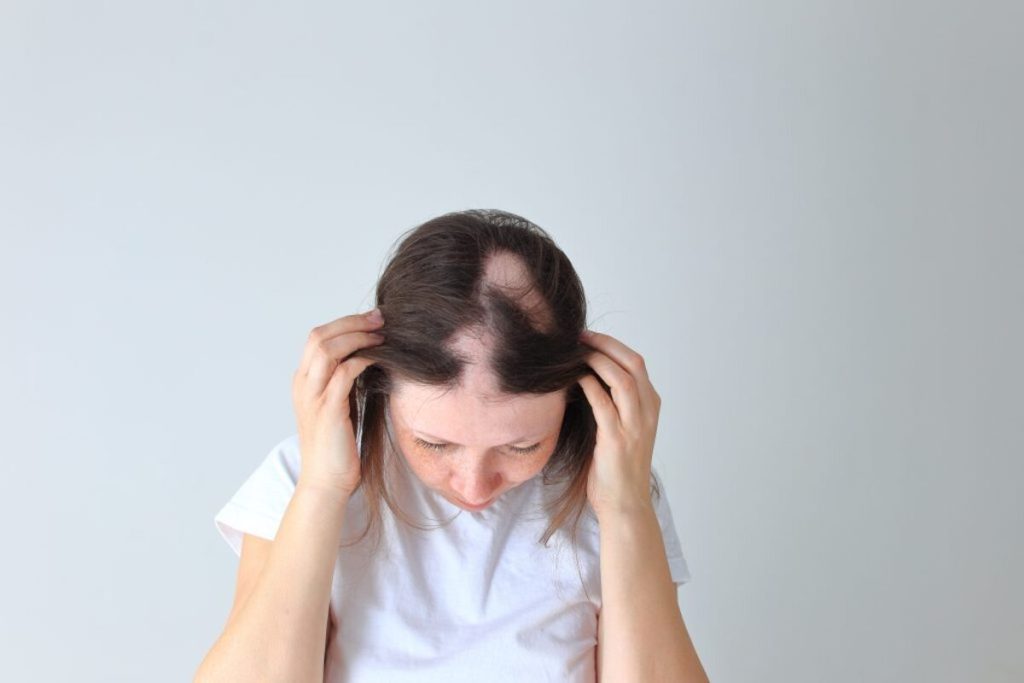 What is alopecia? What are the causes and how to treat?